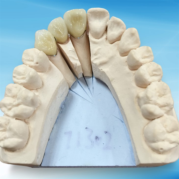 China Customized PFM Bridge China Dental Lab Manufacturers, Suppliers ...